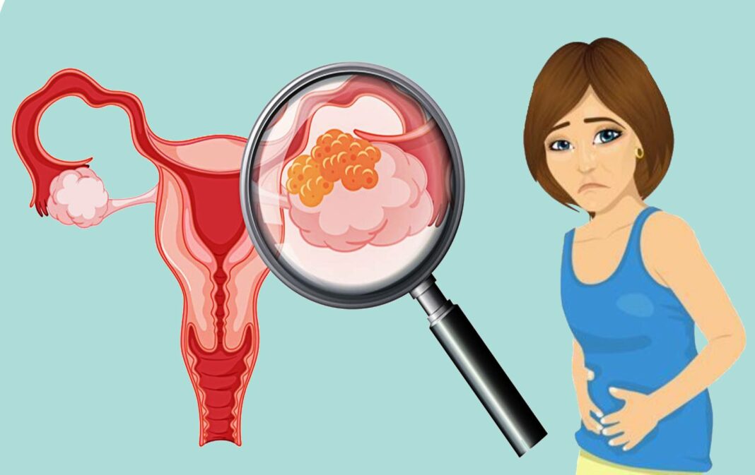 El Cáncer De Ovario SÍntomas Que Debes Saber