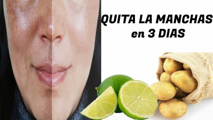 Elimina las manchas de tu cara en solo 3 noches con este truco | Salud Chicas