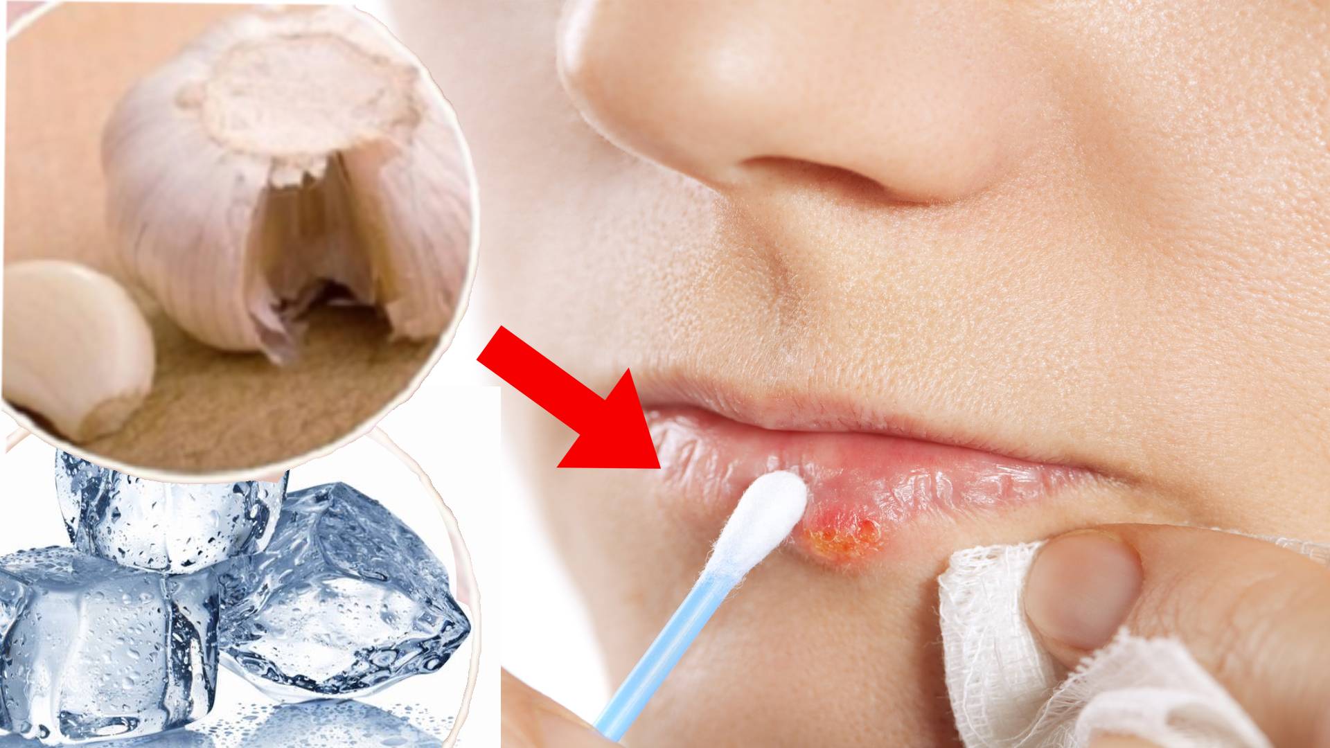 Herpes Labial Como Curar Un Herpes Labial En 1 Solo Día