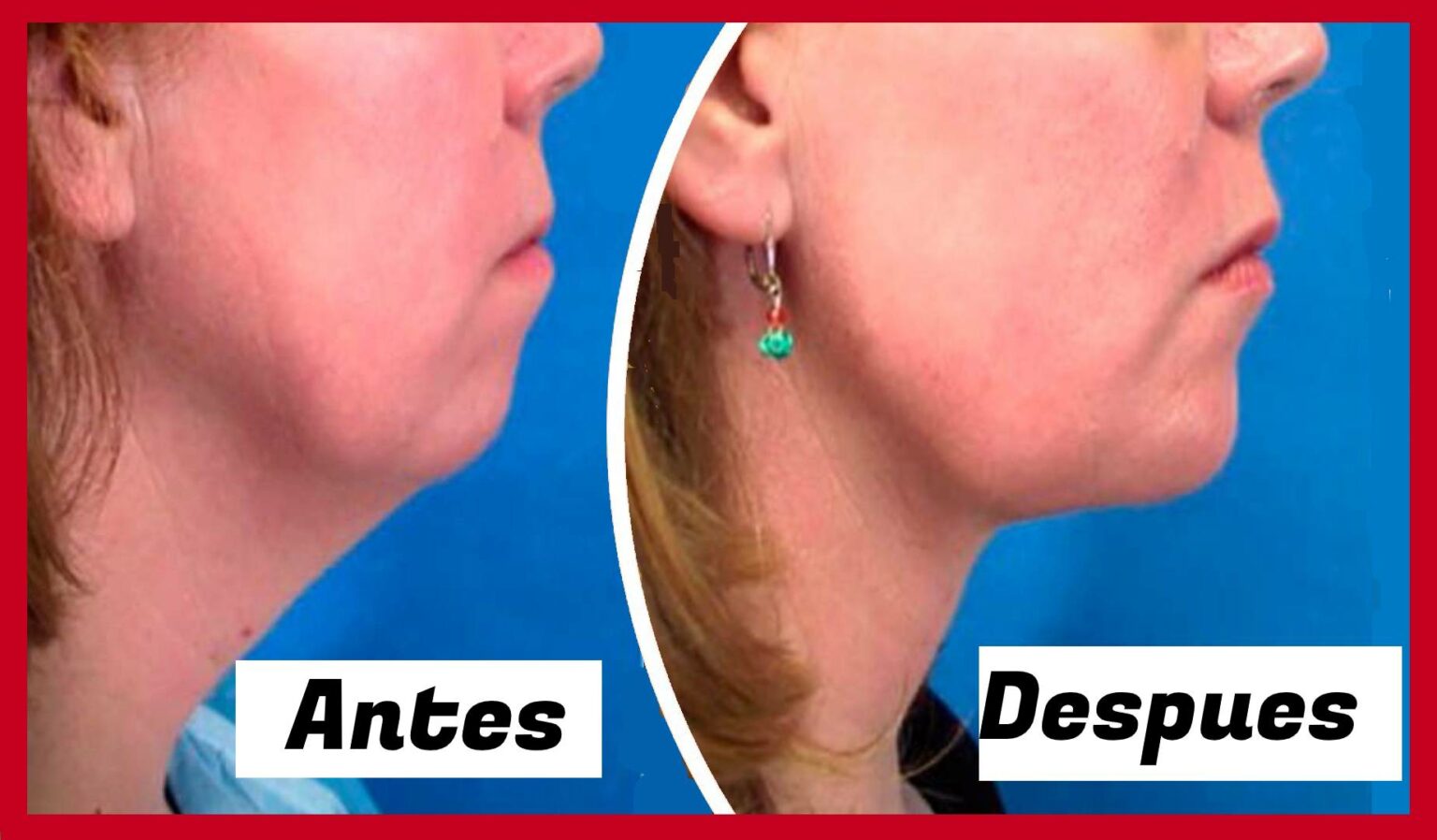 Como Eliminar la Papada Al Instante Y adelgazar la Cara